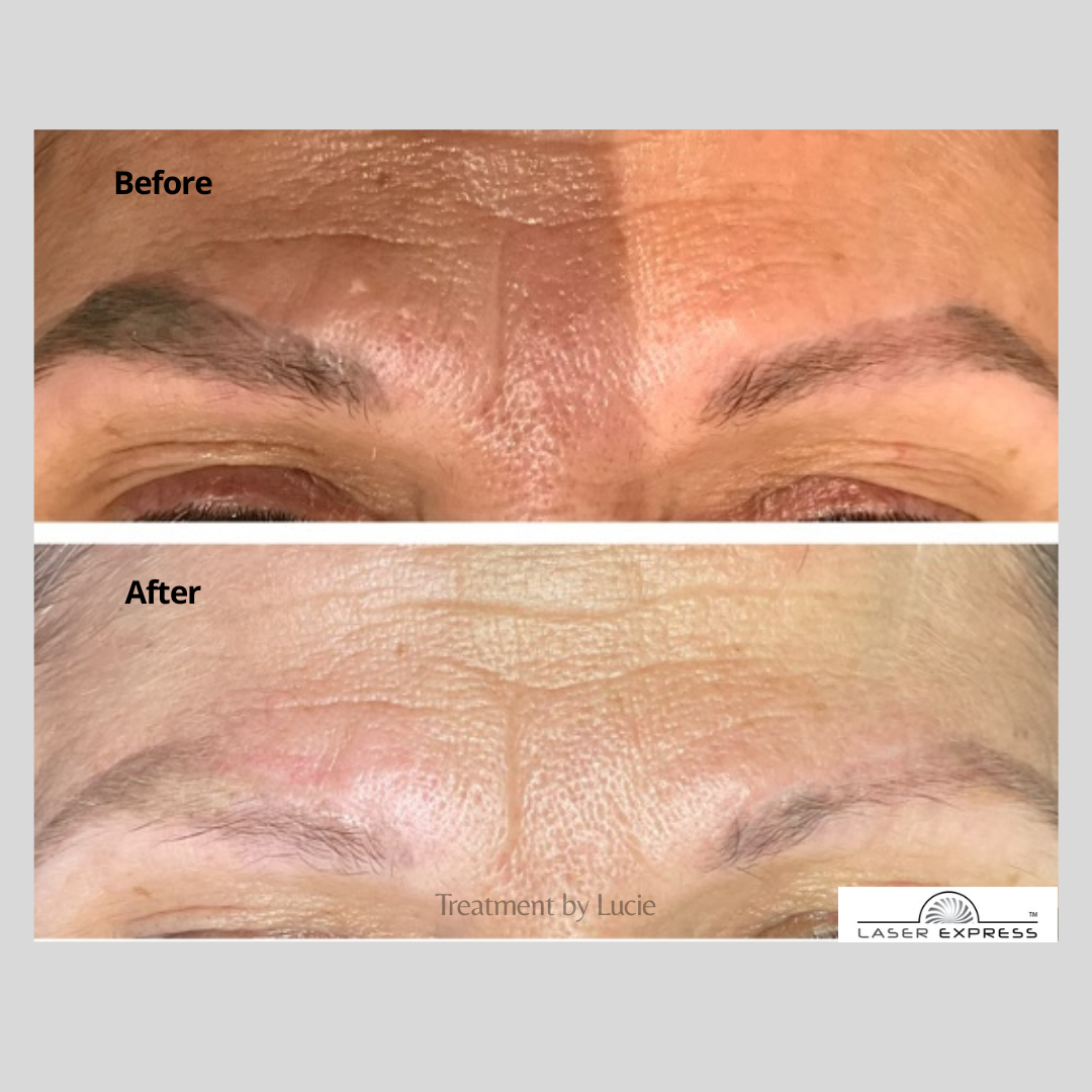 Laser Tattoo Removal Brisbane to Gold Coast | Laser Express – Laser ...