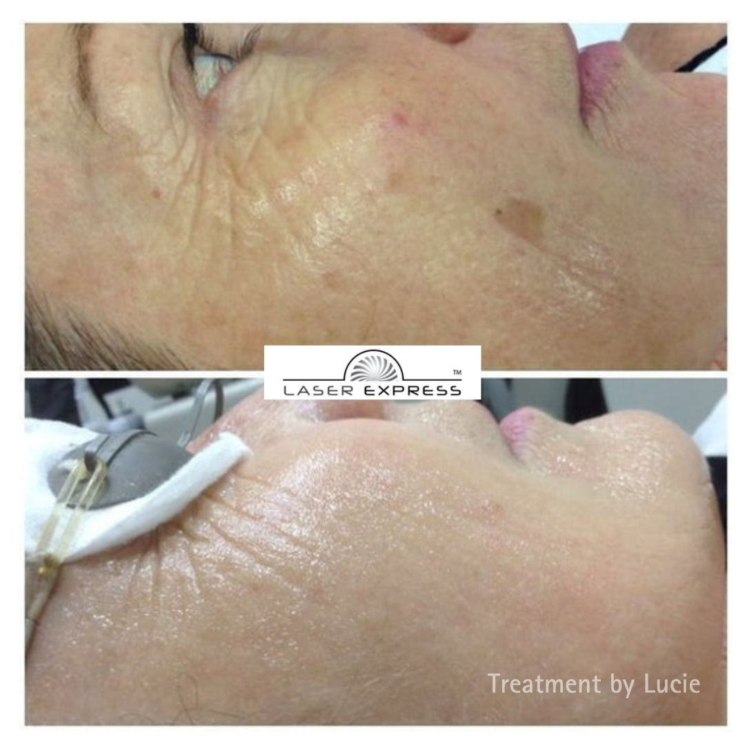 Laser and IPL Pigmentation Removal – Laser Express Services Pty Ltd