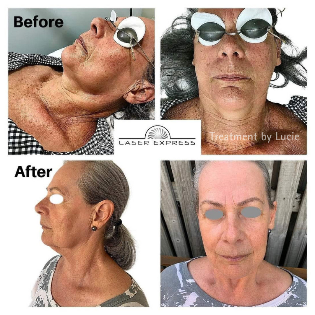 Before and After – Laser Express Services Pty Ltd