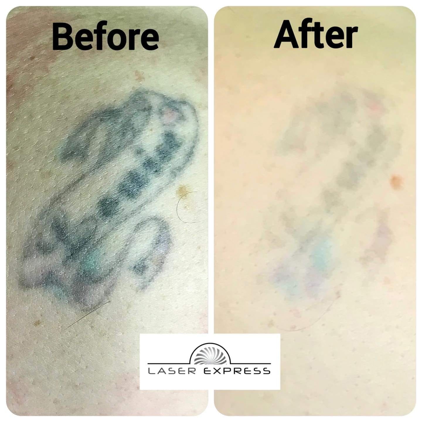 Laser Tattoo Removal Brisbane to Gold Coast | Laser Express – Laser ...