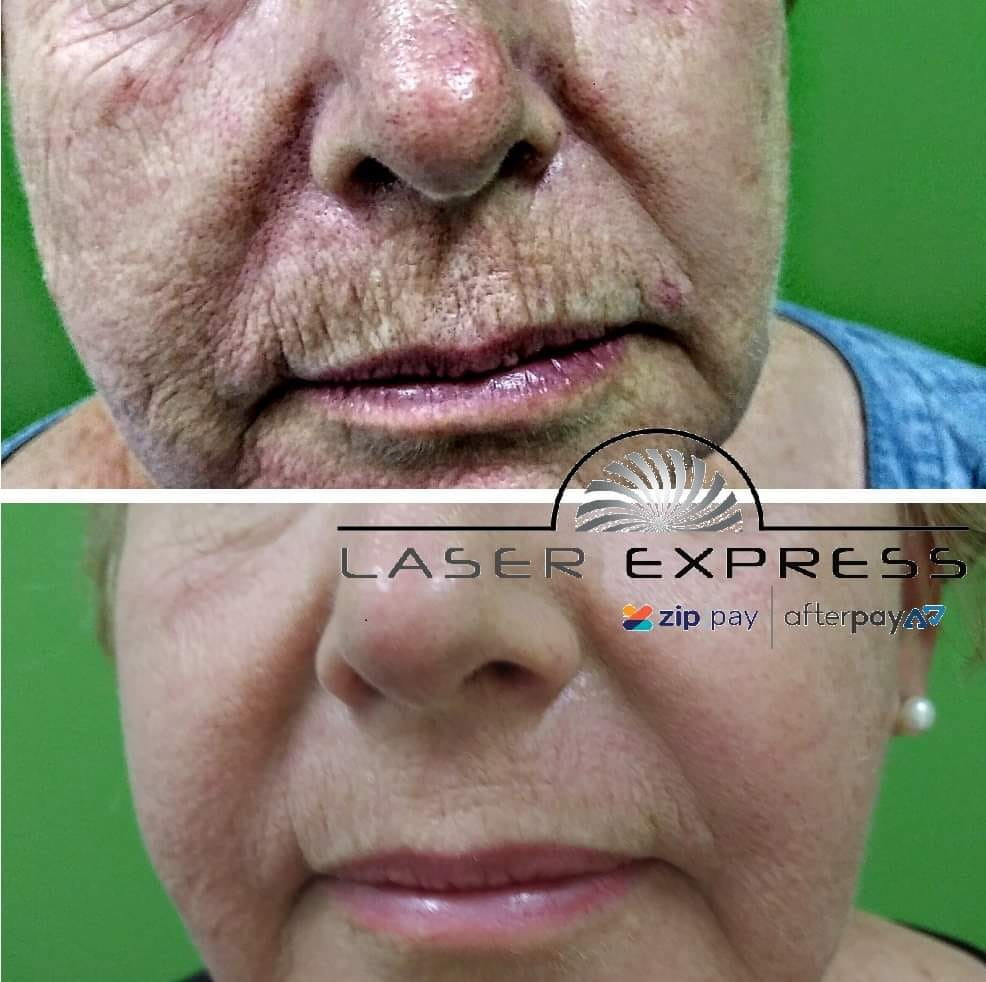 Plasma Pen Wrinkle Removal Brisbane to Gold Coast | Laser Express – Laser Express Services Pty Ltd